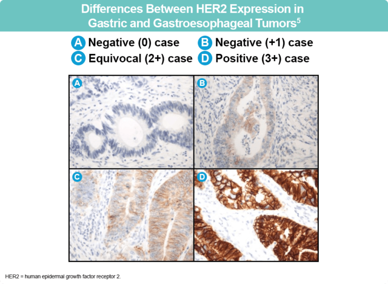 HER2 Assessment – HER2